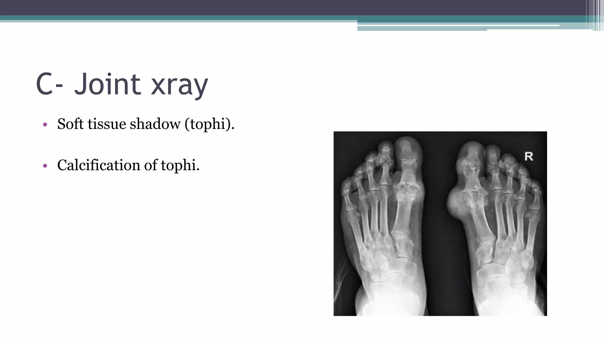Hyperuricemia and Gout | PPTX