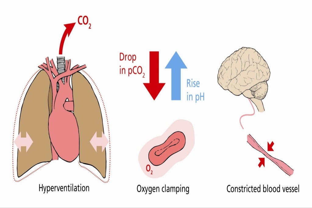 Hyperventilation syndrome.