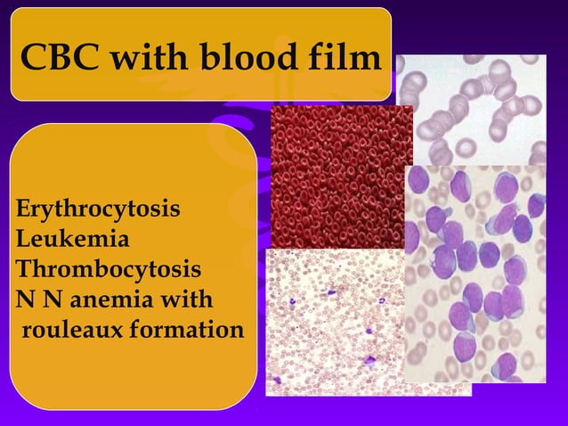 Hyperviscosity syndrome | PPT | Blood Disorders | Diseases and Conditions