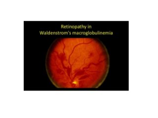 Hyperviscosity Retinopathy