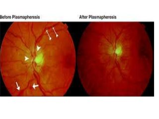 Hyperviscosity Retinopathy
