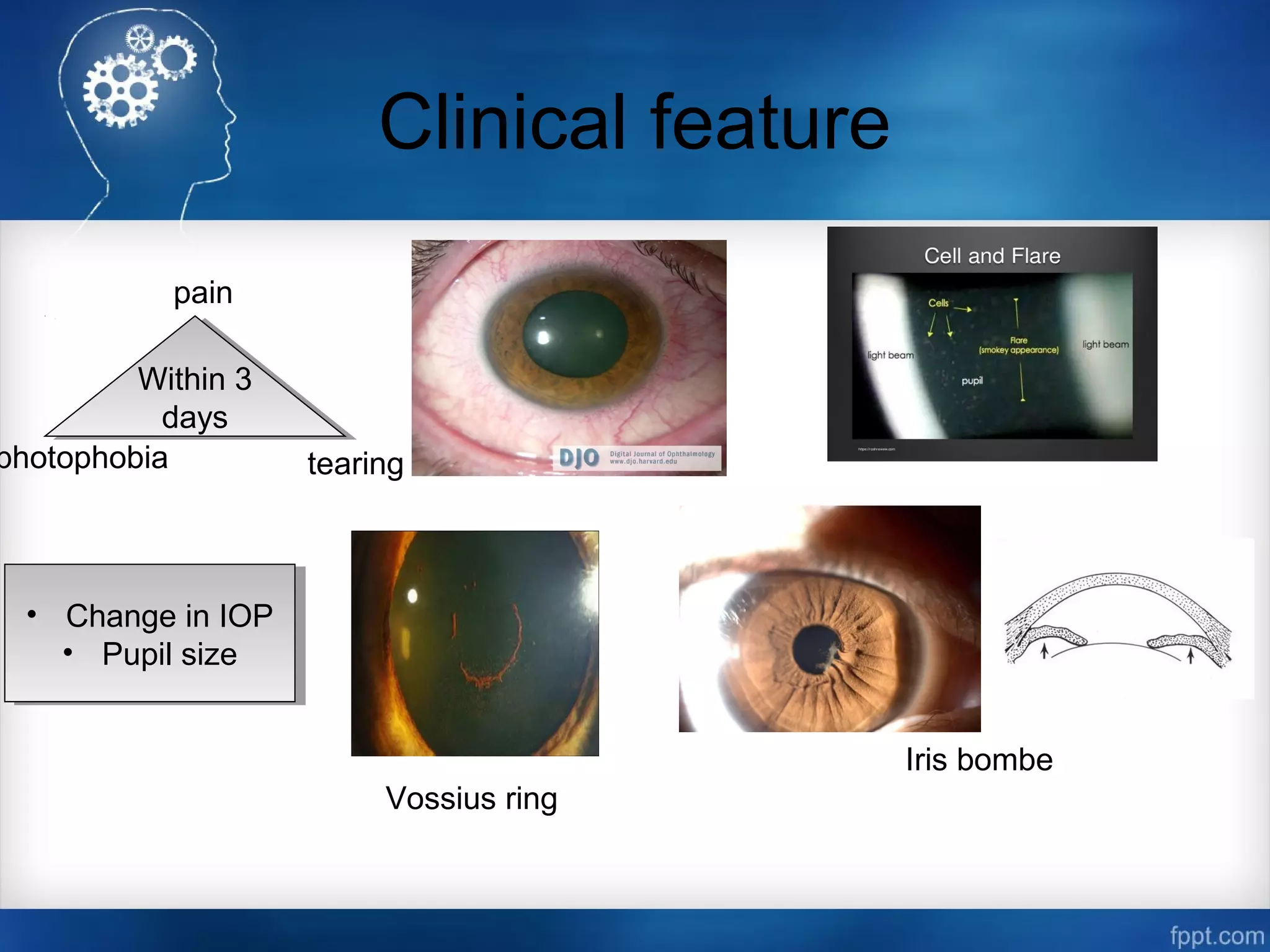 case of a blunt trauma to the left eye causing traumatic hyphema | PPT