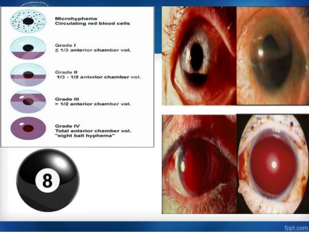 case of a blunt trauma to the left eye causing traumatic hyphema