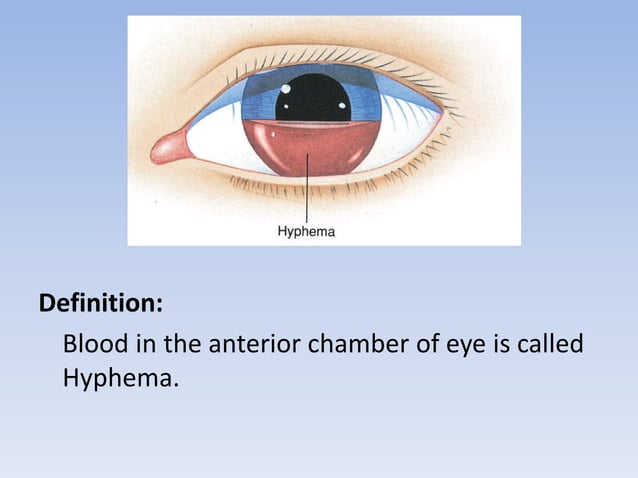 Hyphema | PPT