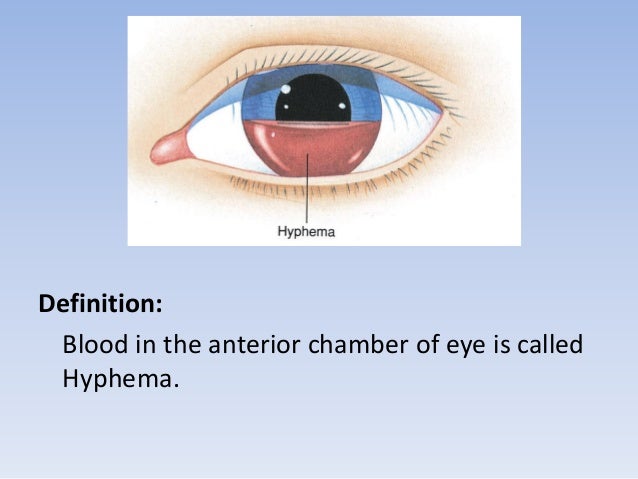 Hyphema