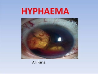 Hyphema | PPTX