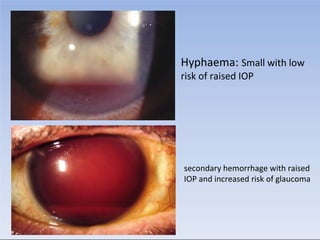 Hyphema | PPTX