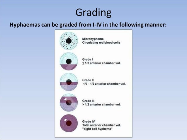 Hyphema | PPTX | Blood Disorders | Diseases and Conditions