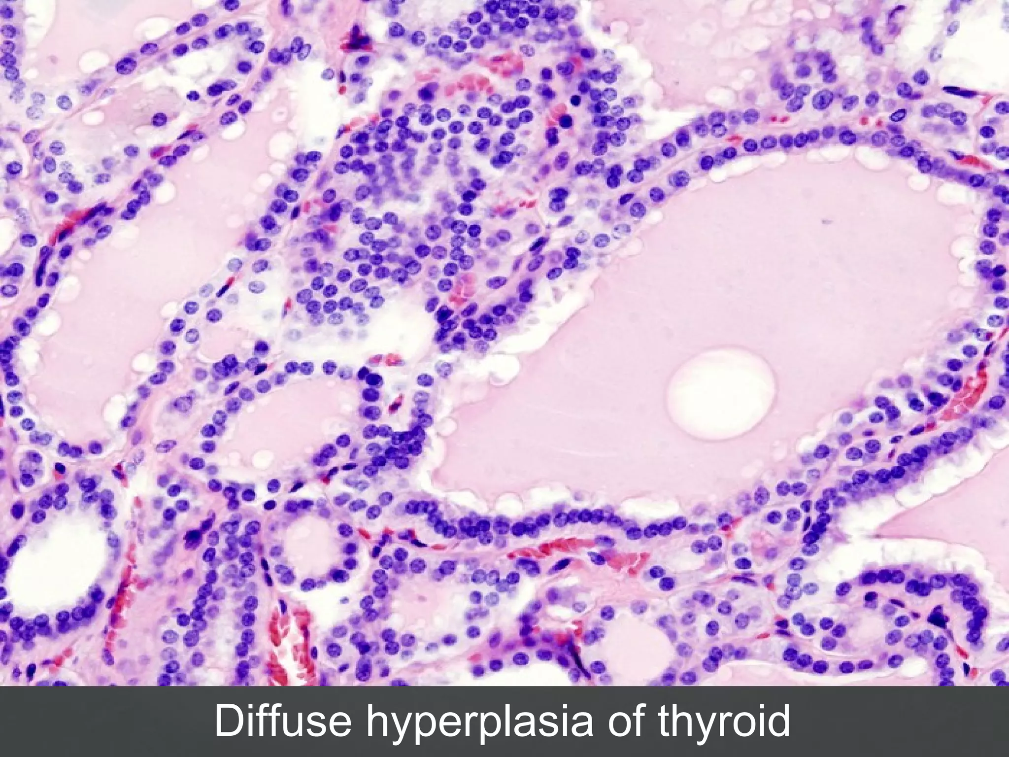 Hypo and Hyper Thyroidism | PPT
