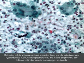 Hypo and Hyper Thyroidism | PPT