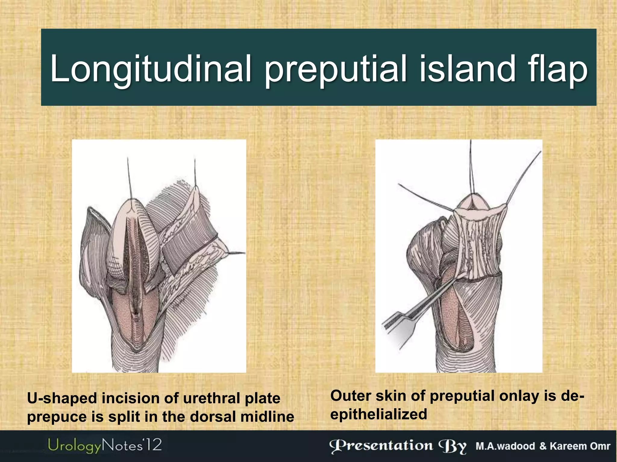 Hypospadias 2 new techniques: longitudinal preputial flap & single ...