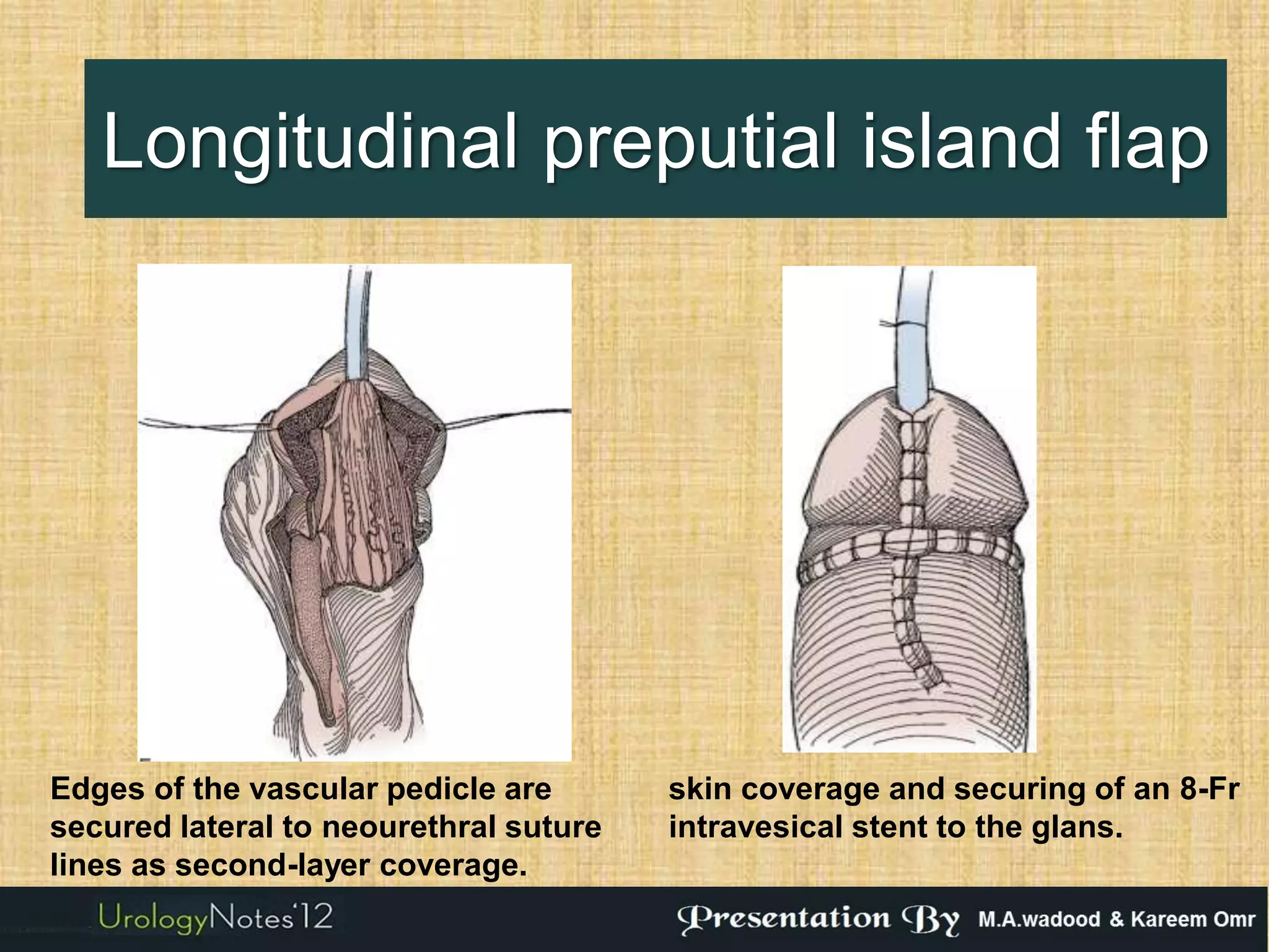 Hypospadias 2 new techniques: longitudinal preputial flap & single ...