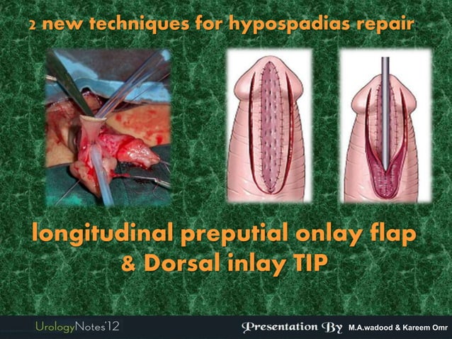 Hypospadias 2 new techniques: longitudinal preputial flap & single ...