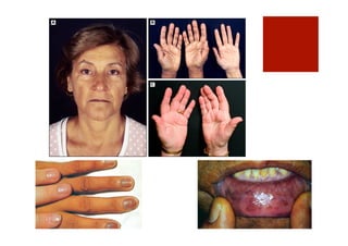 Hypoadrenalism feb 2015 | PDF