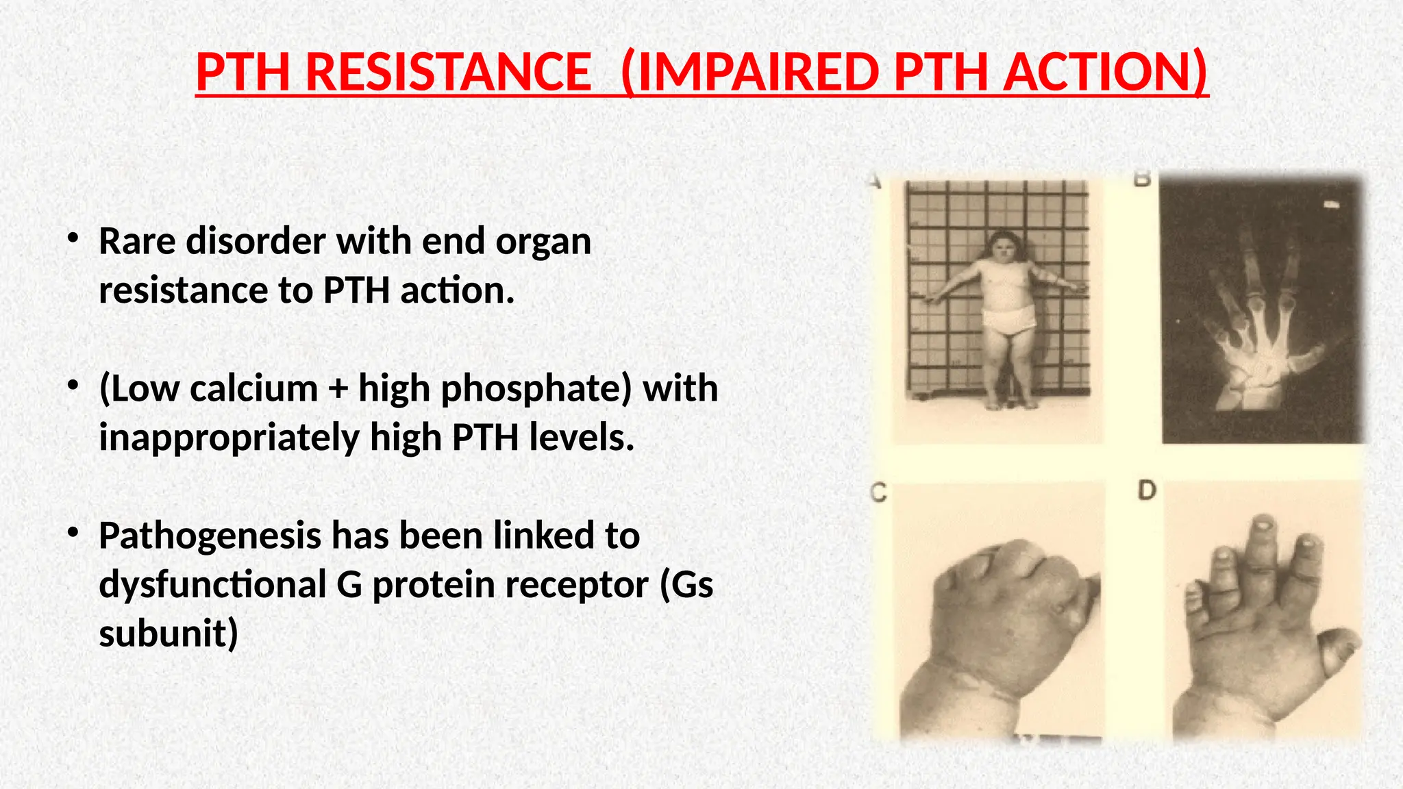 HYPOCALCEMIA: causes and approach to management | PPTX