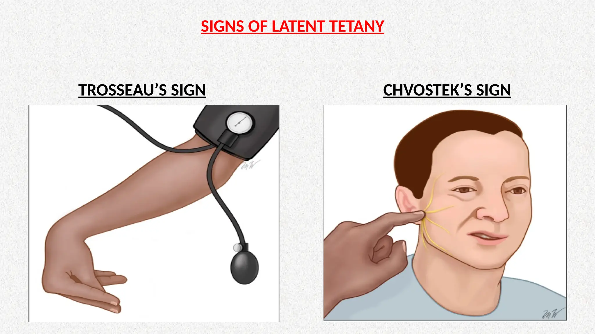 HYPOCALCEMIA: causes and approach to management | PPTX
