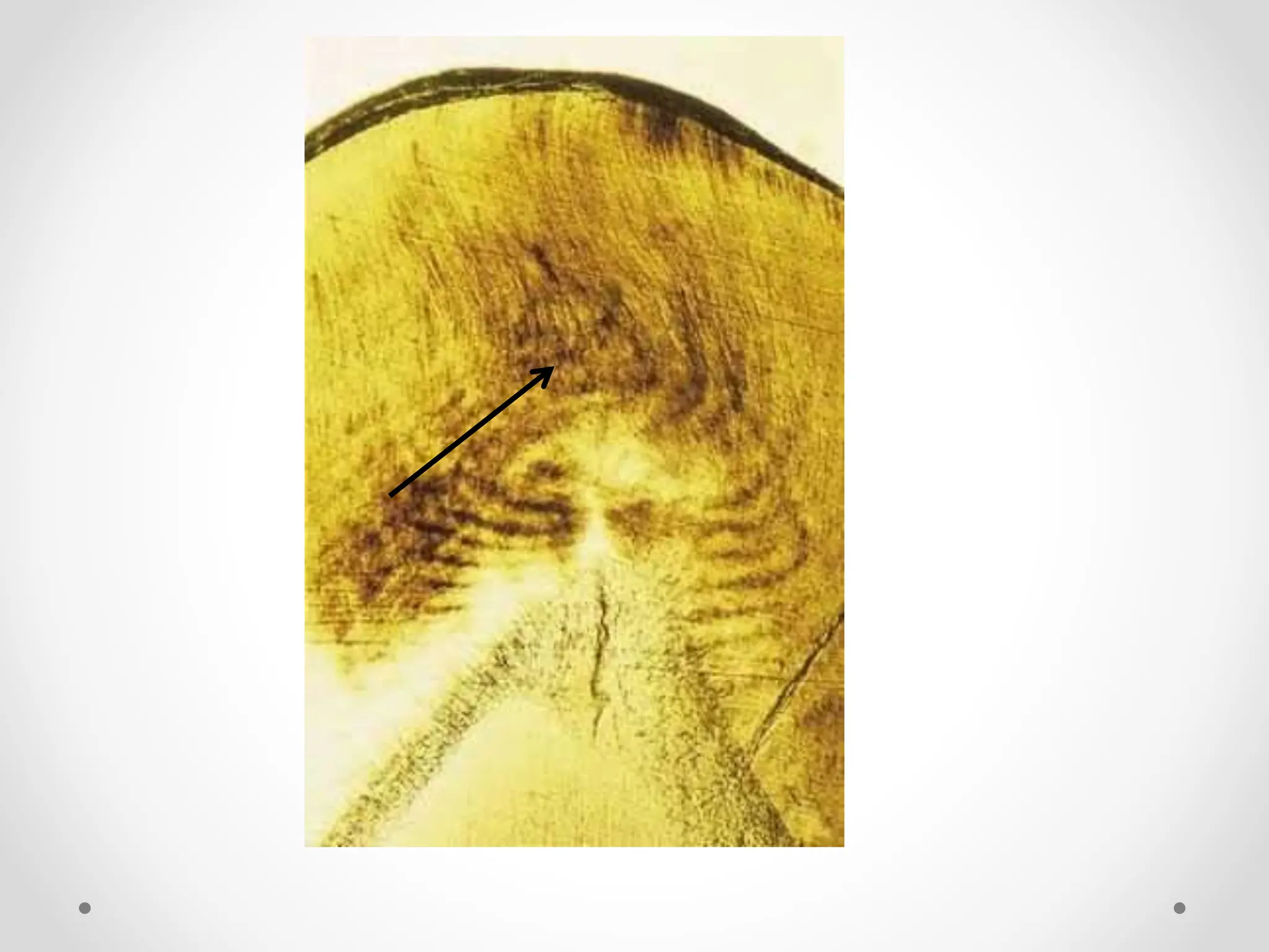 HYPOCALCIFIED STRUTURES OF ENAMEL.pptx