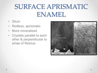 HYPOCALCIFIED STRUTURES OF ENAMEL.pptx