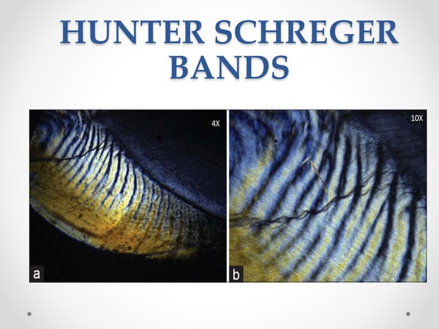 HYPOCALCIFIED STRUTURES OF ENAMEL.pptx