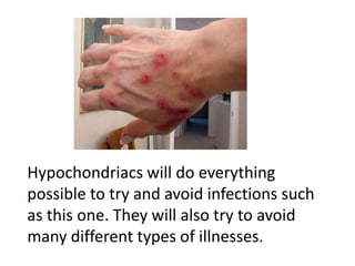 Hypochondriasis | PPTX