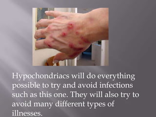 Hypochondriasis | PPTX