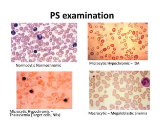 Macrocytic Hypochromic Anemia Slide Observations