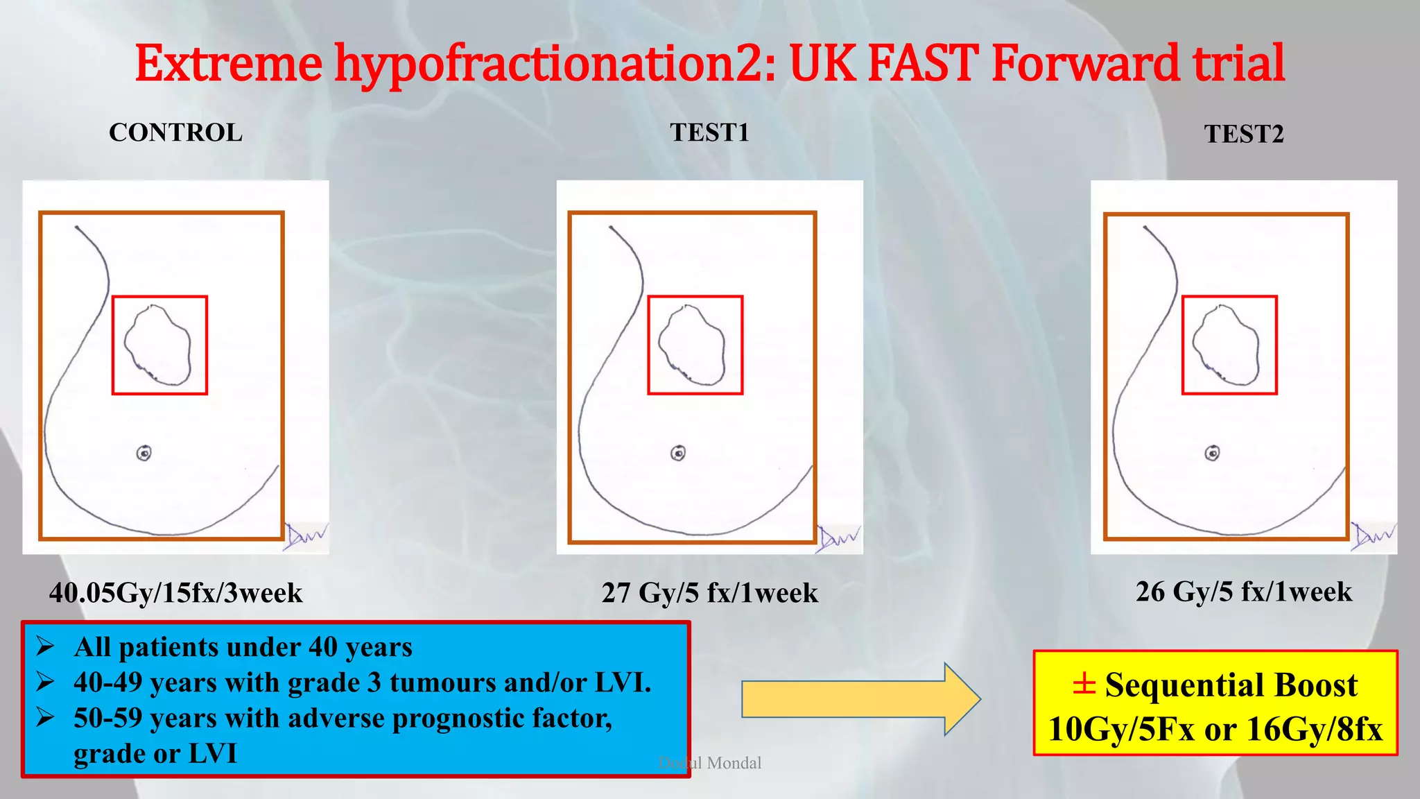 Hypofractionation in breast cancer | PDF