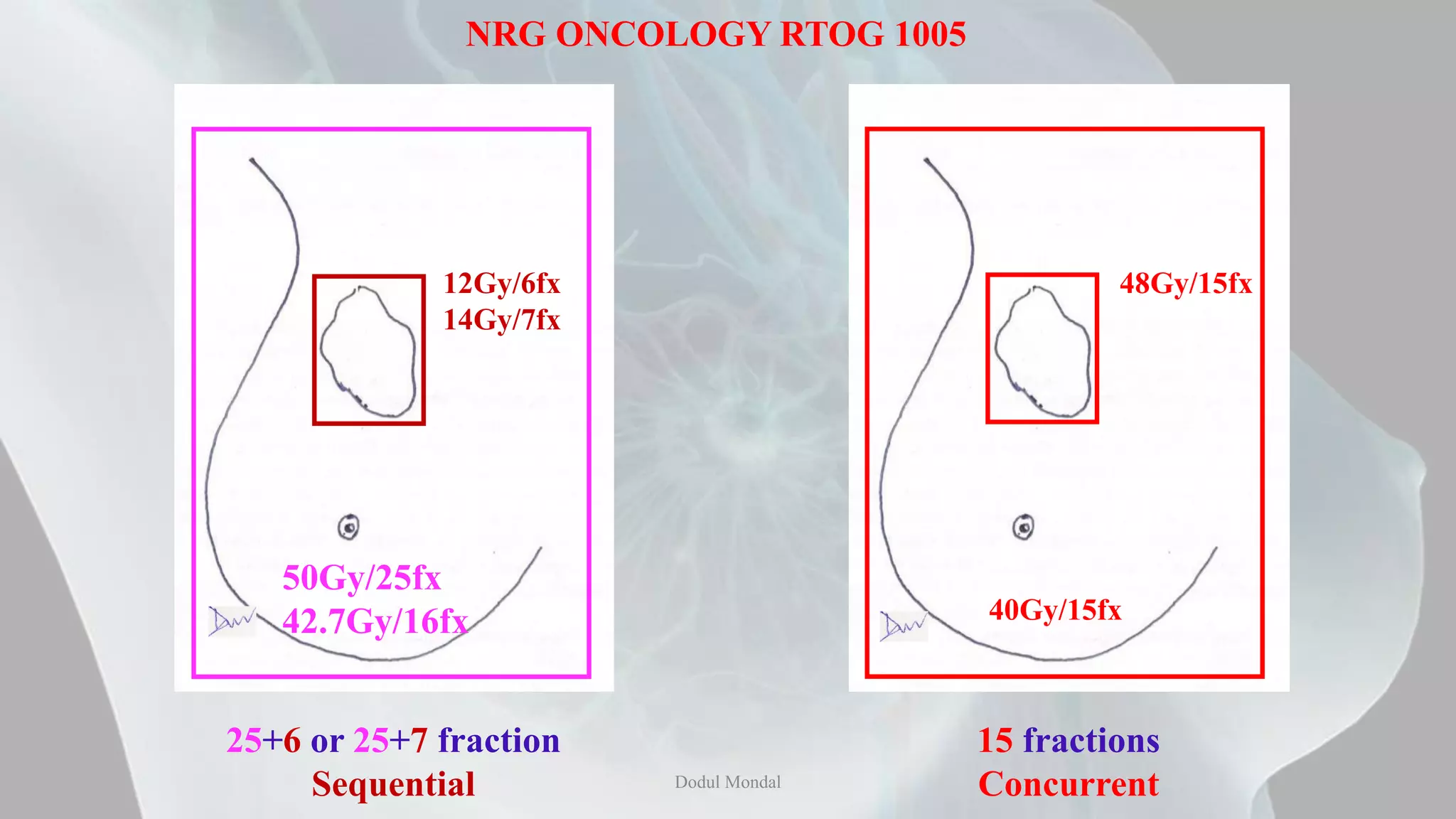 Hypofractionation in breast cancer | PDF
