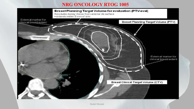 Hypofractionation in breast cancer | PDF