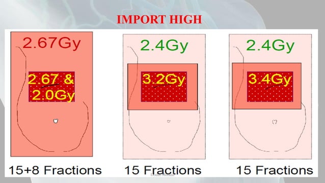 Hypofractionation in breast cancer | PDF