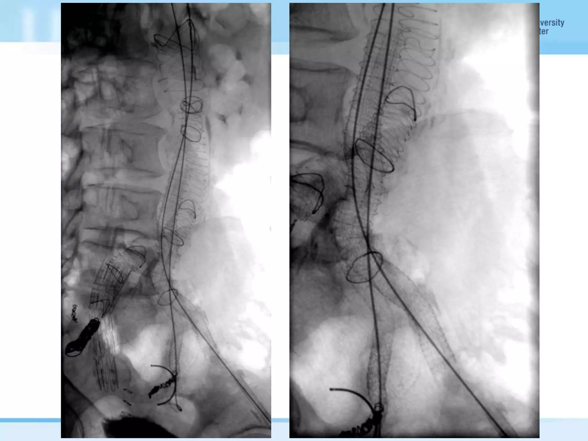 Hypogastric artery preservation with sandwich technique short summary ...