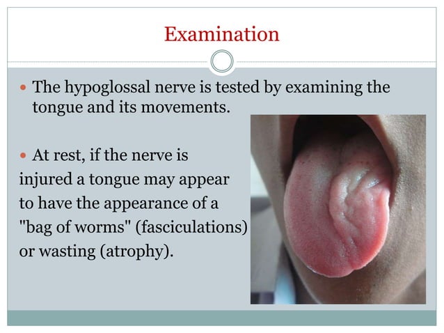 hypoglossal n. injury.pptx of hypoglossal nerve injury | PPT