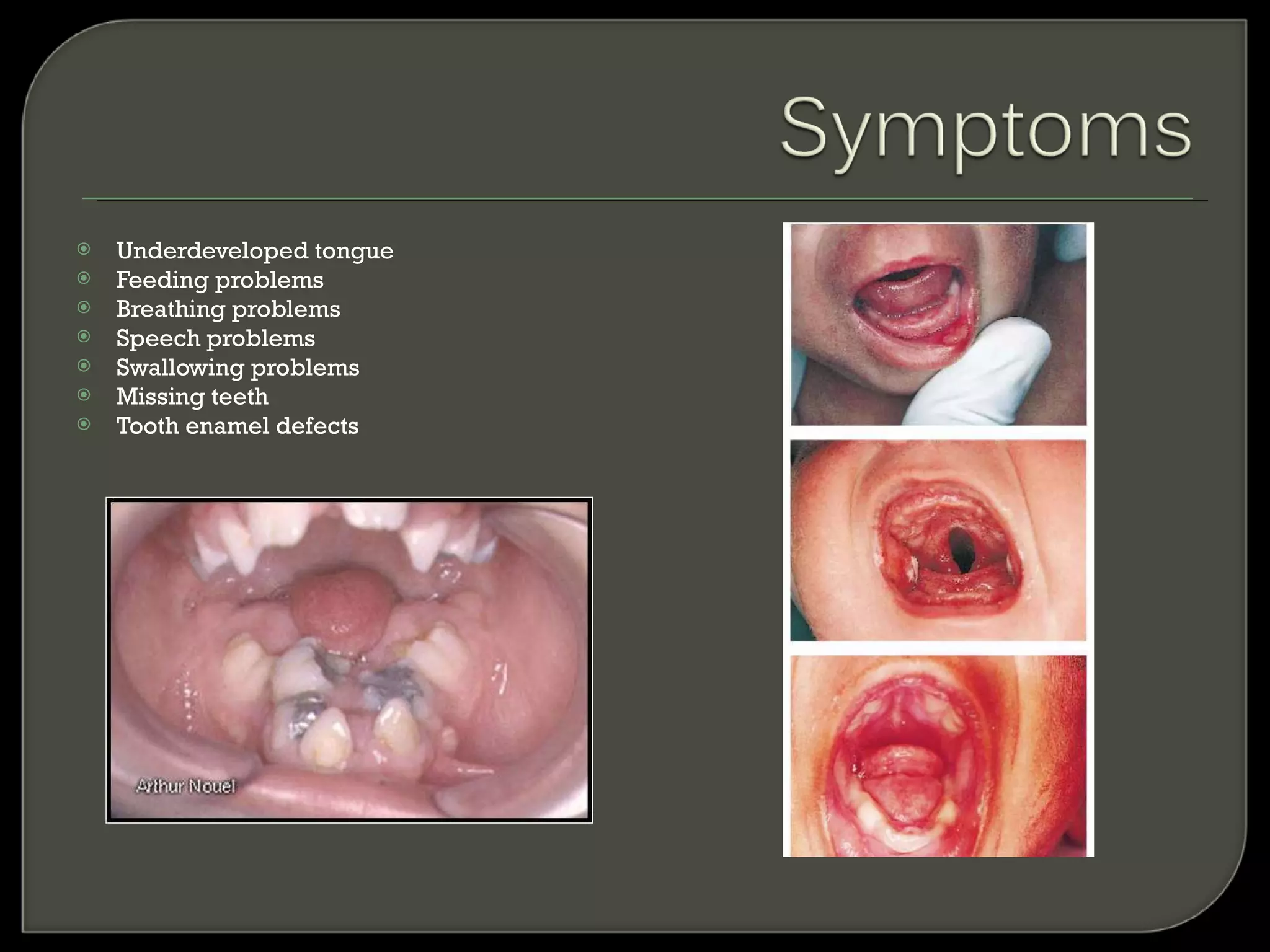 Hypoglossia | PPT