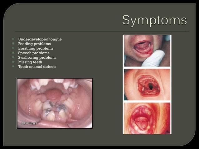 Hypoglossia | PPT