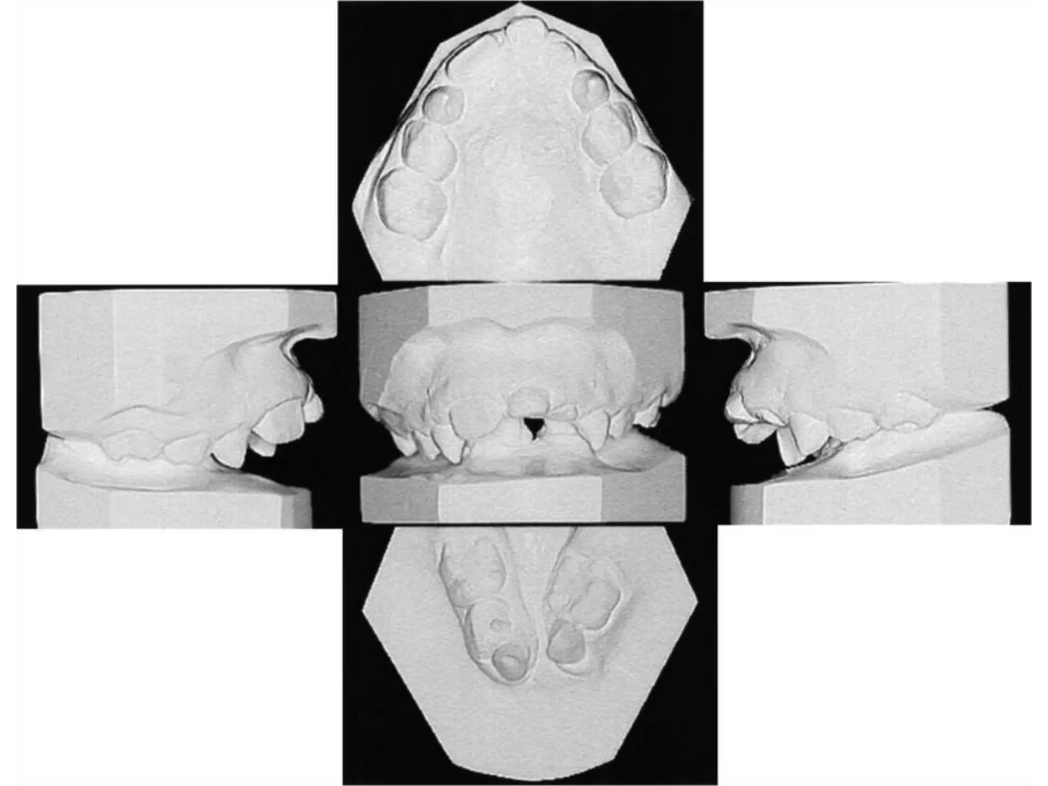 Hypoglossia hypodactylia | PPTX