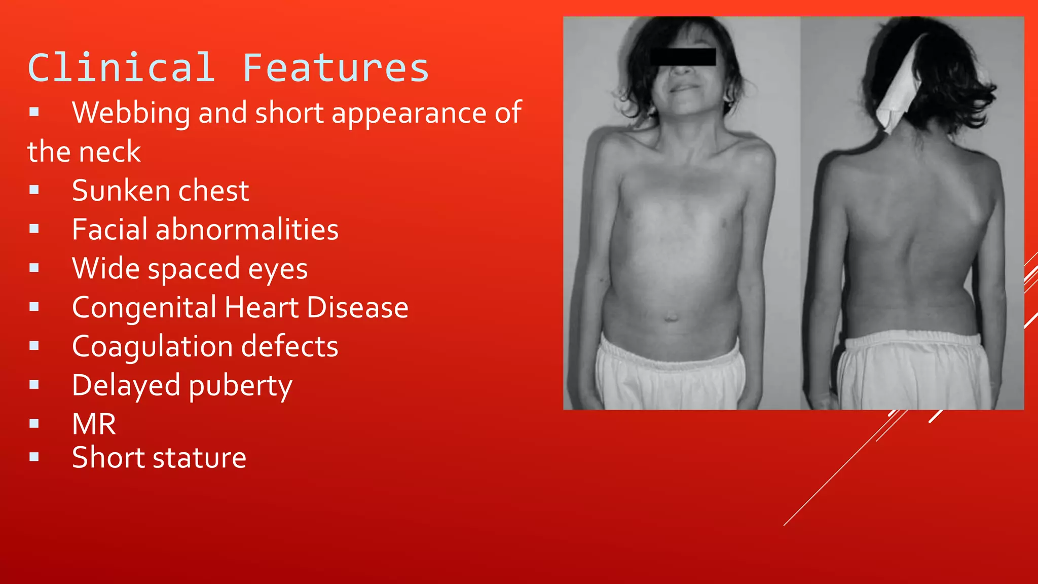 Hypogonadism | PPTX