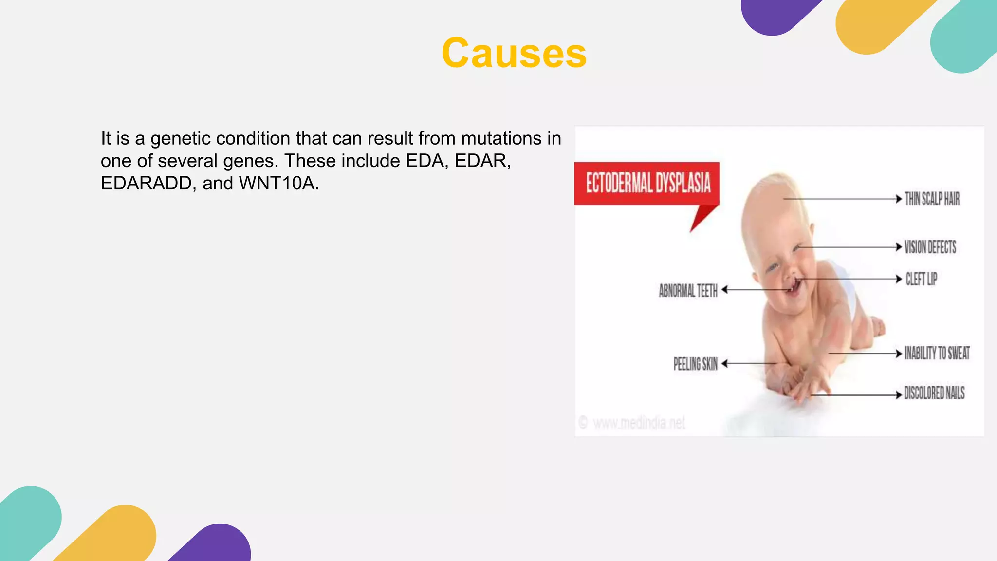 hypohidrotic ectodermal dysplasia.pptx