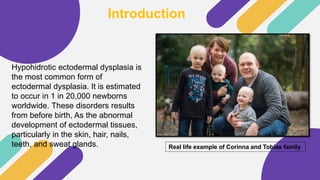 hypohidrotic ectodermal dysplasia.pptx