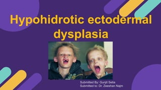 Hypohidrotic Ectodermal Dysplasia