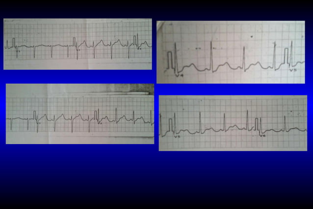 ECG: Hypokalemia | PPT | Digestive Disorders | Diseases and Conditions