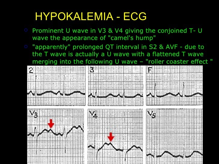 CME - Hypokalemia