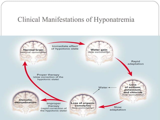 Hyponatremia ppt .final | PPT | Blood Disorders | Diseases and Conditions