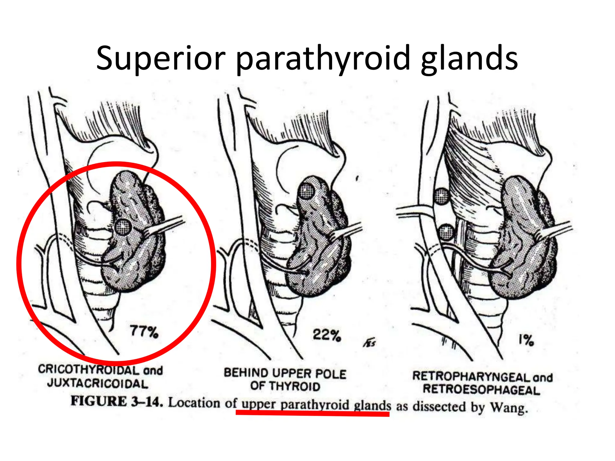 Hypoparathyroidism after Thyroidectomy amir sharing.pptx