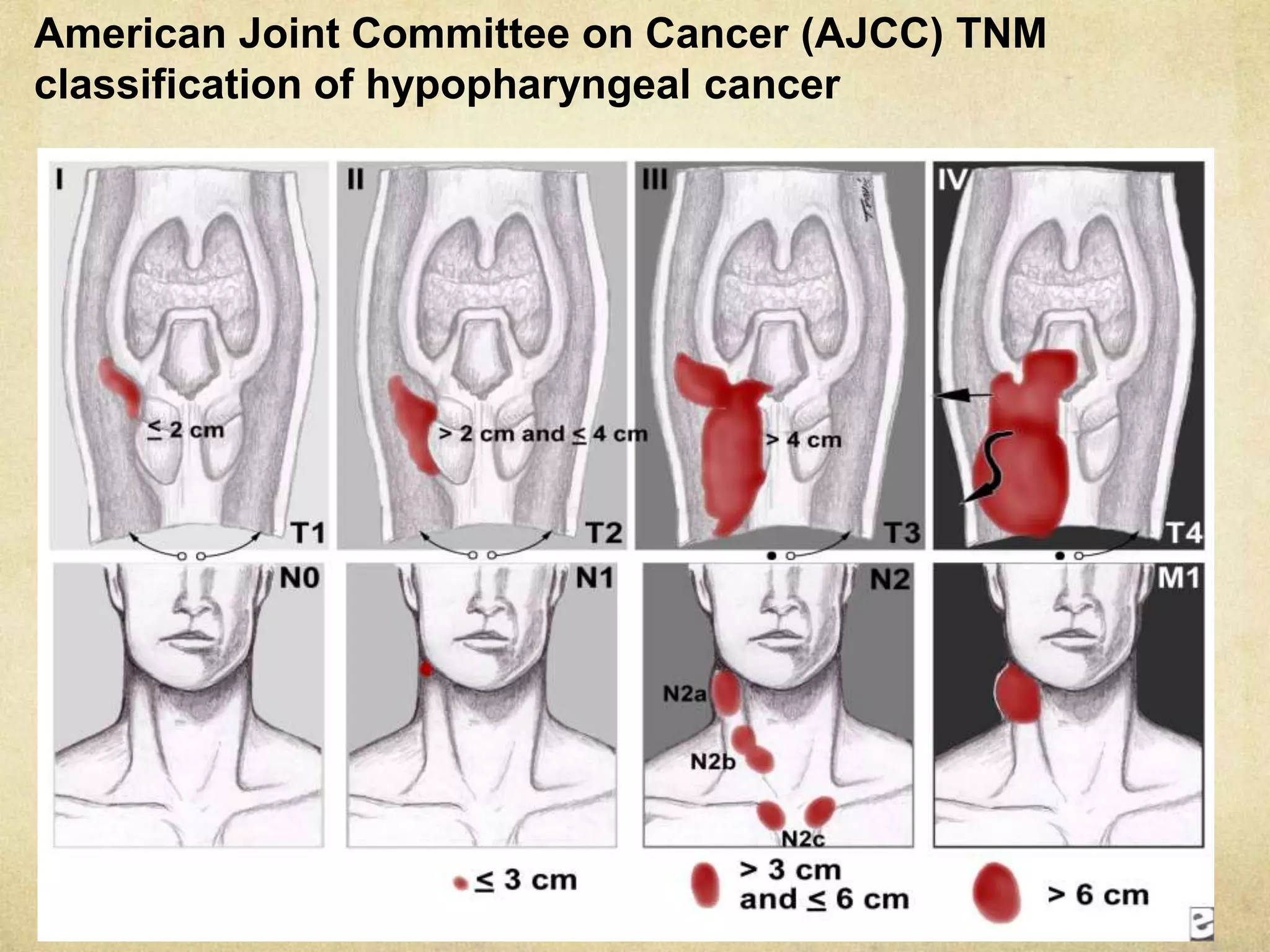 Hypopharyngeal cancer | PPTX