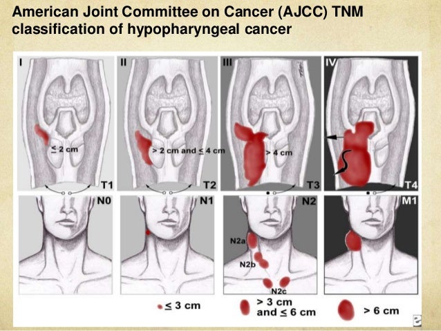 Hypopharyngeal cancer