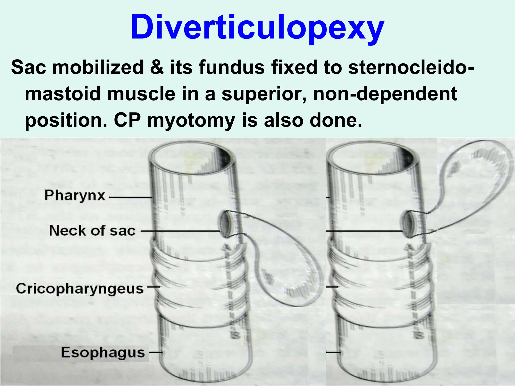 Hypopharyngeal pouch & stylalgia ent .ppt