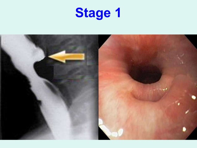 Hypopharyngeal pouch & stylalgia ent .ppt | Death, Injury, or Military ...