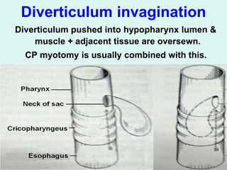 Hypopharyngeal pouch & stylalgia ent .ppt