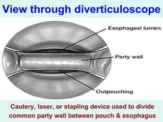 Hypopharyngeal pouch & stylalgia ent .ppt