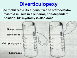 Hypopharyngeal pouch & stylalgia ent .ppt